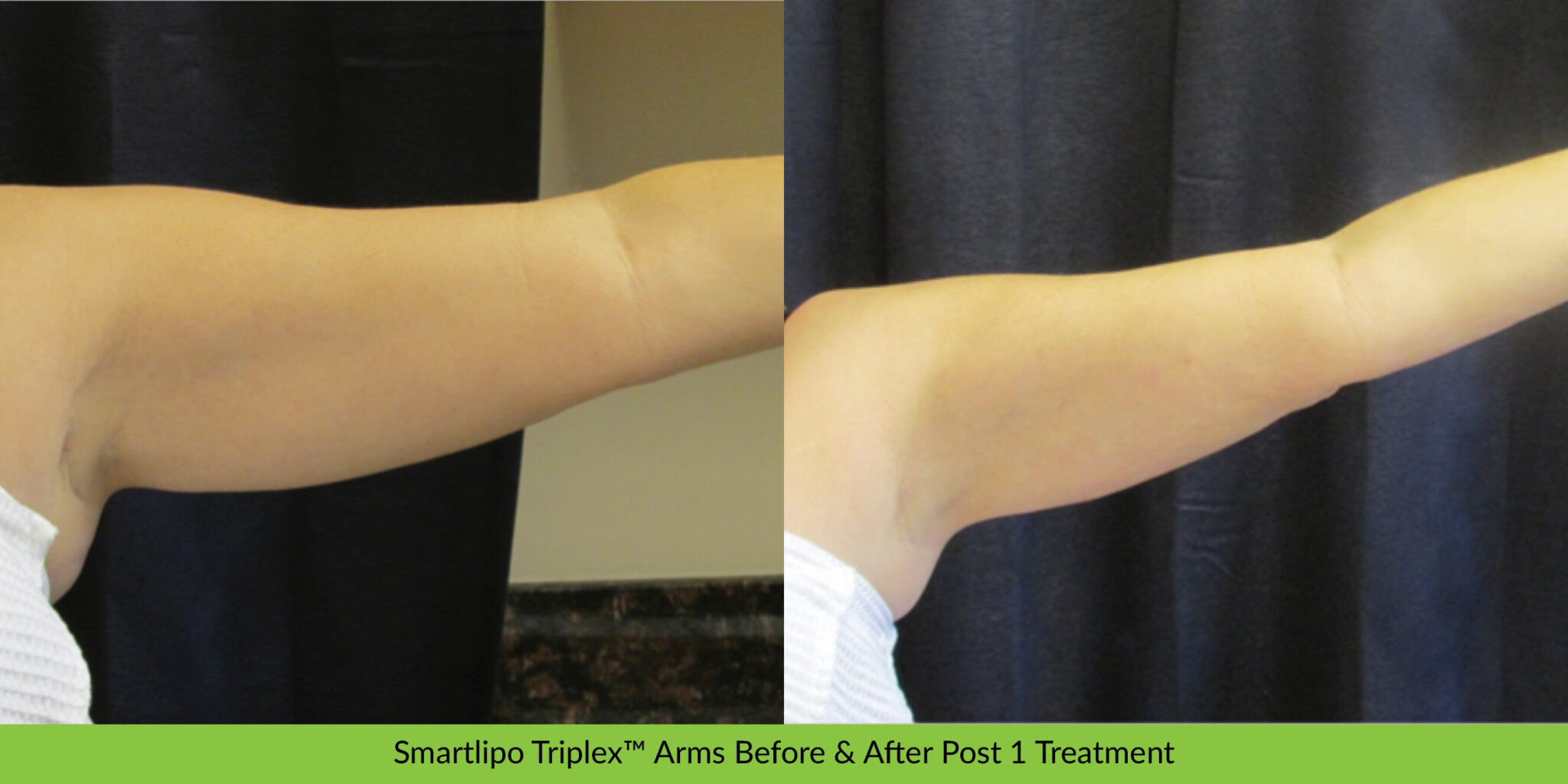 SmartLipo | Abloom Med Spa | Glendale, AZ